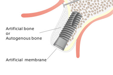 Guided Bone Regeneration - Skin & Smiles
